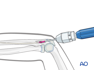 ESIN for Ulna, bowing