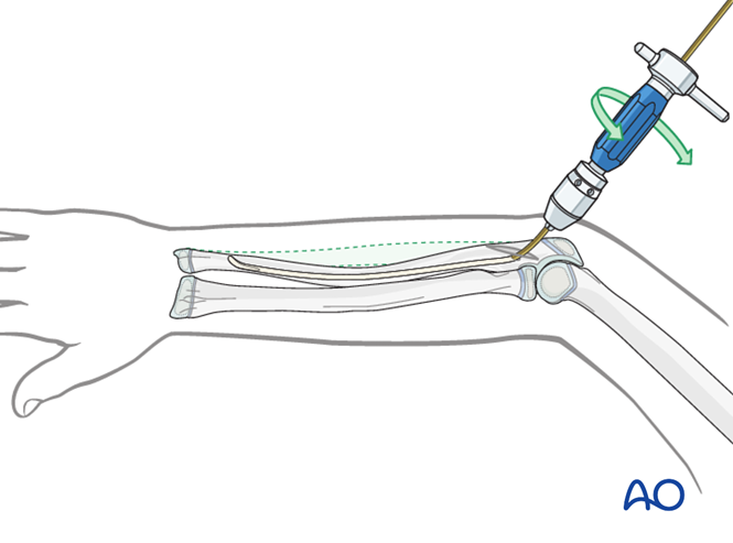 ESIN for Ulna, bowing