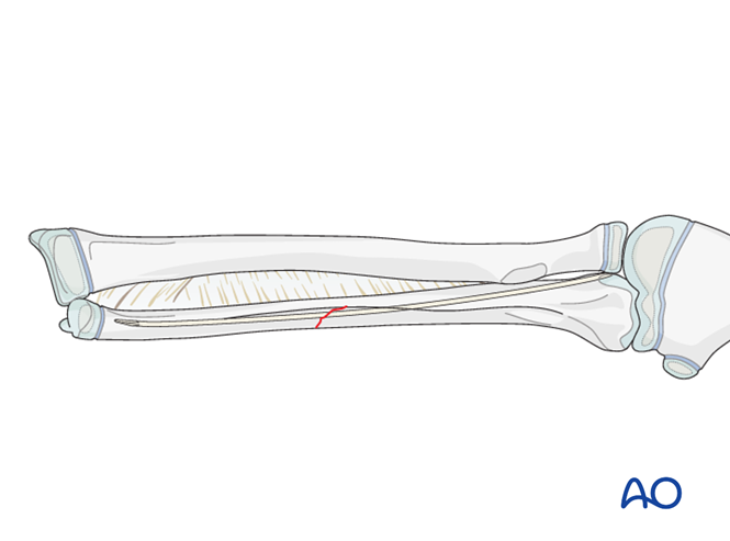 ESIN for Ulna, greenstick