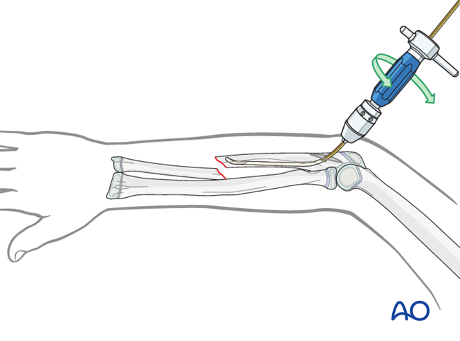 ESIN for Ulna, complete oblique or spiral