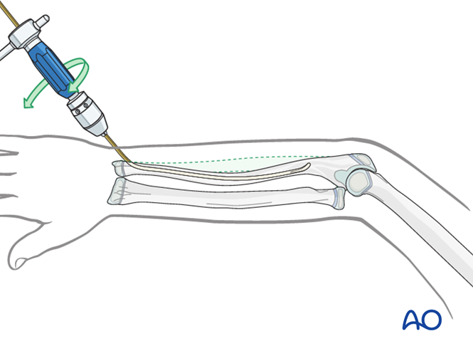 Monteggia lesion, bowing of ulna: ESIN (retrograde)
