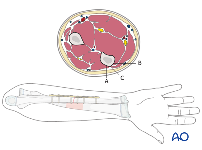 Ulna, transverse fracture: open reduction, compression plating