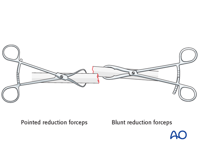 Radius, multifragmentary fracture: open reduction, bridge plating