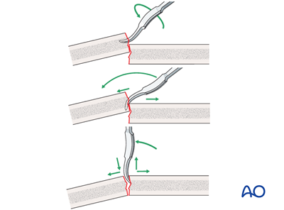 Ulna, transverse fracture: open reduction, compression plating