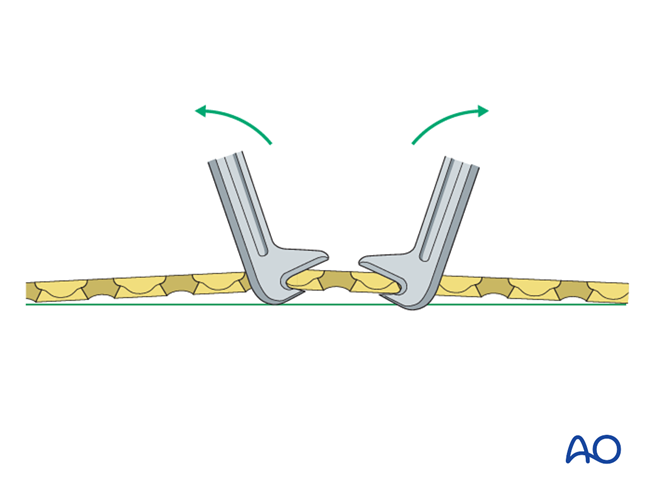 Ulna, transverse fracture: open reduction, compression plating