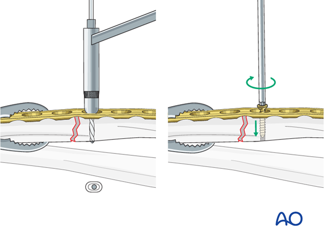 Open reduction; plate fixation for Radius, complete transverse, simple