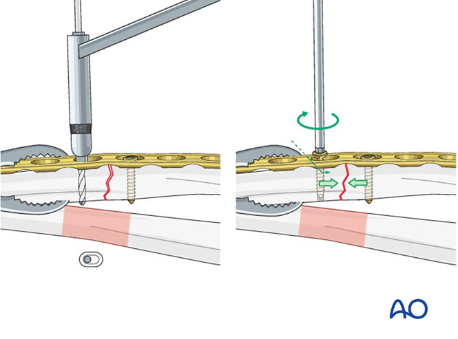 Radius, transverse fracture: open reduction, compression plating