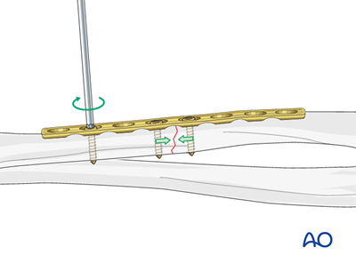 Open reduction; plate fixation for Radius, complete transverse, simple