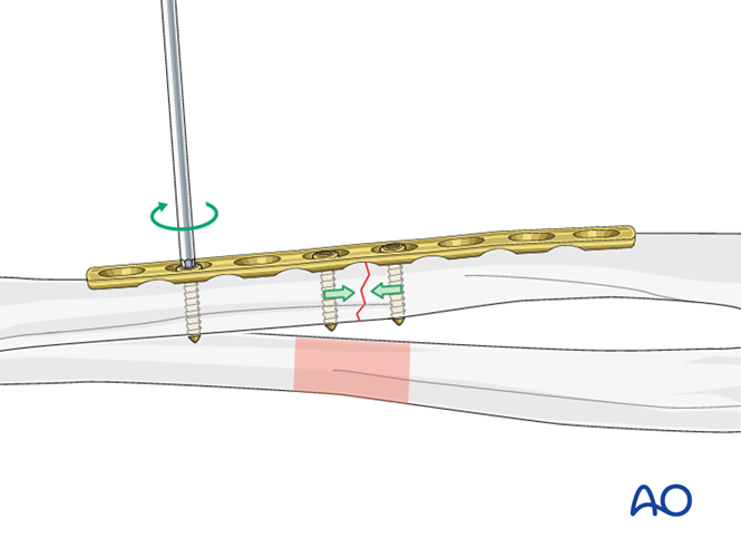 Ulna, transverse fracture: open reduction, compression plating