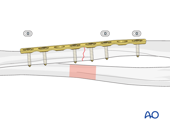 Ulna, transverse fracture: open reduction, compression plating