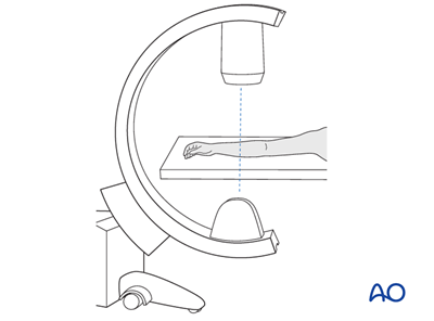 ESIN for Both bones, combination of radial and ulnar fracture
