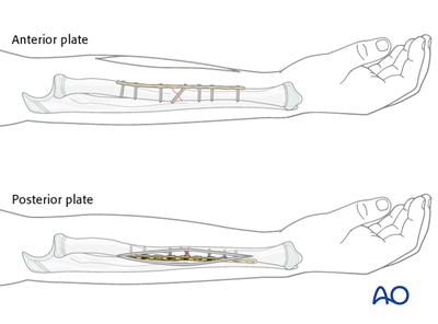 Open reduction; plate and screw fixation for Radius, complete oblique ...