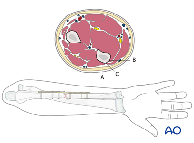 Open reduction; plate and screw fixation for Ulna, complete oblique or ...
