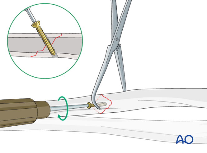 Open reduction; plate and screw fixation for Radius, complete oblique ...