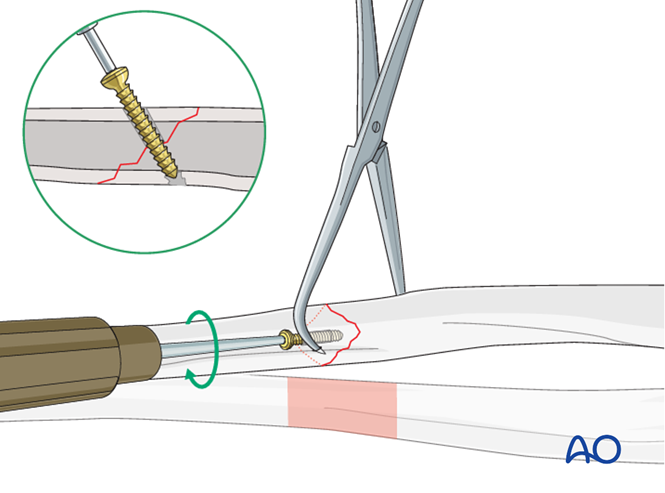 Radius, oblique fracture: open reduction, plate and screw fixation