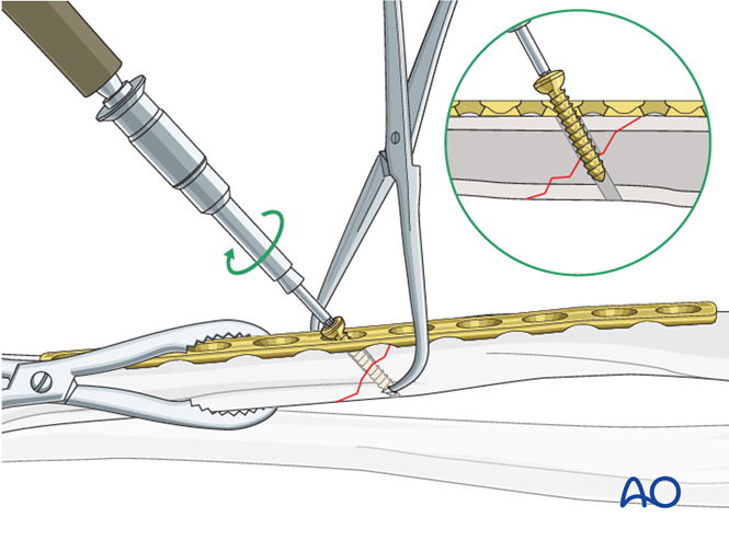 Open reduction; plate and screw fixation for Radius, complete oblique ...