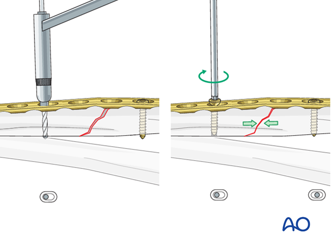 Open reduction; plate and screw fixation for Radius, complete oblique ...