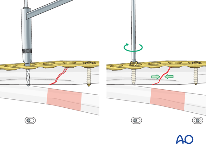 Radius, oblique fracture: open reduction, plate and screw fixation
