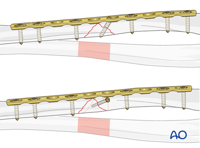 Radius, oblique fracture: open reduction, plate and screw fixation