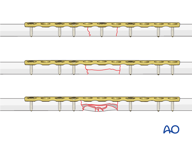 Open reduction; bridge plating for Ulna, complete oblique or spiral