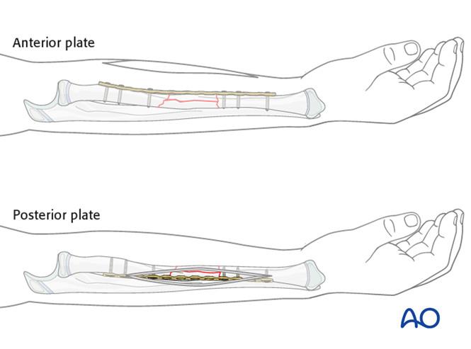 Open reduction; bridge plating for Radius, complete oblique or spiral
