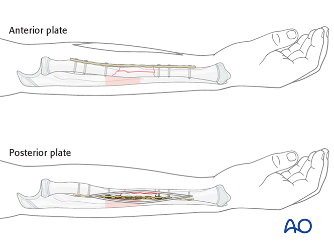 Radius, multifragmentary fracture: open reduction, bridge plating