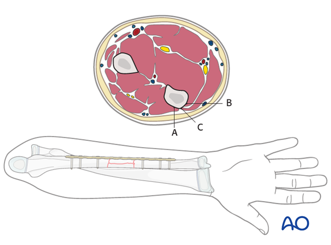 Open reduction; bridge plating for Ulna, complete oblique or spiral