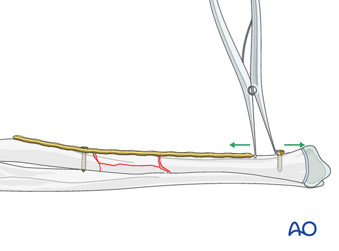 Open reduction; bridge plating for Radius, complete oblique or spiral