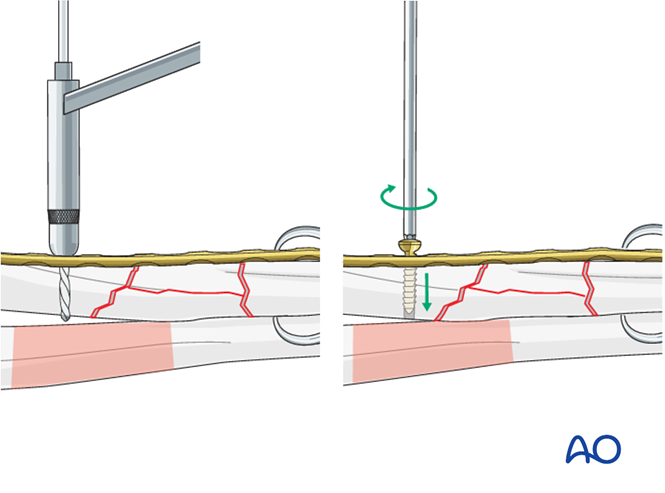 Radius, multifragmentary fracture: open reduction, bridge plating