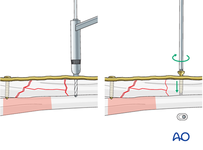Radius, multifragmentary fracture: open reduction, bridge plating
