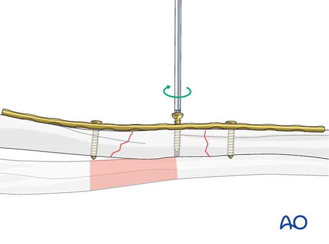Radius, multifragmentary fracture: open reduction, bridge plating