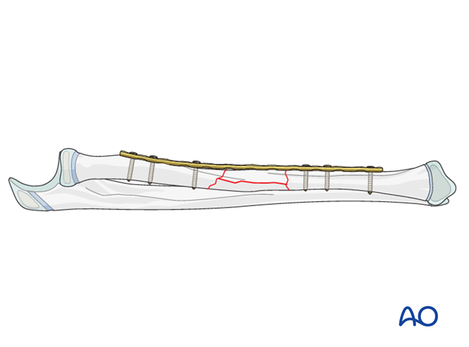 Open reduction; bridge plating for Radius, complete oblique or spiral