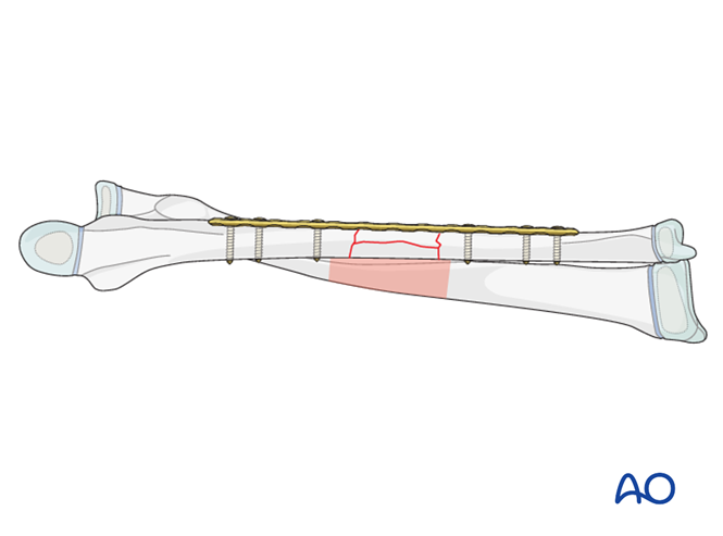 Ulna, multifragmentary fracture: open reduction, bridge plating