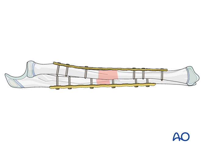 Open reduction; plate fixation for Both bones, combination of radial ...