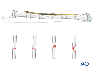 Open reduction; plate fixation for Both bones, combination of radial ...