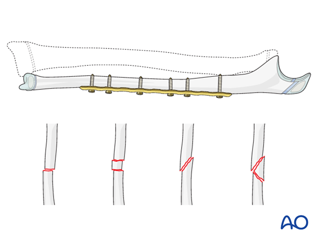 Open reduction; plate fixation for Both bones, combination of radial ...