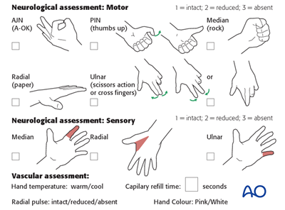 Closed reduction; cast fixation with/without wedging for Both bones ...