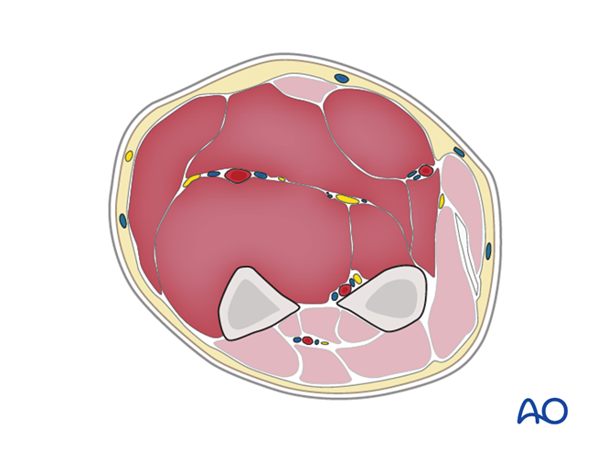 Compartment syndrome