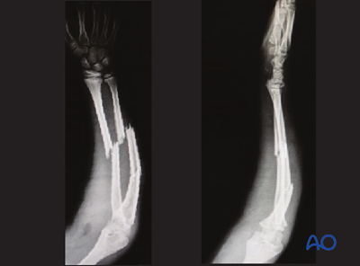 Fracture instability and malalignment