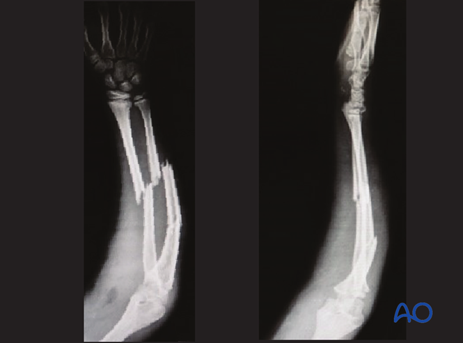 Fracture instability and malalignment