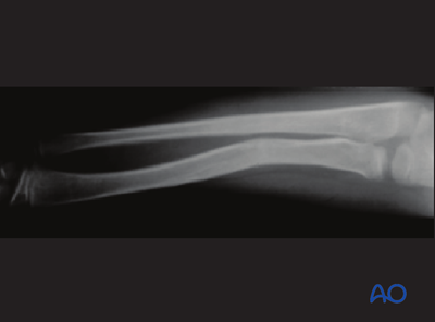 Fracture instability and malalignment