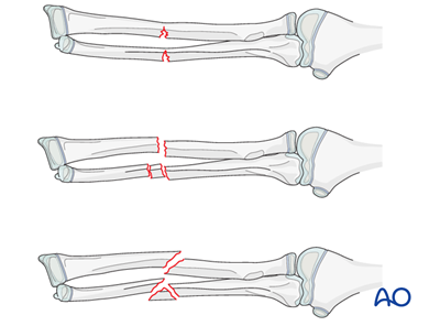 Fracture instability and malalignment