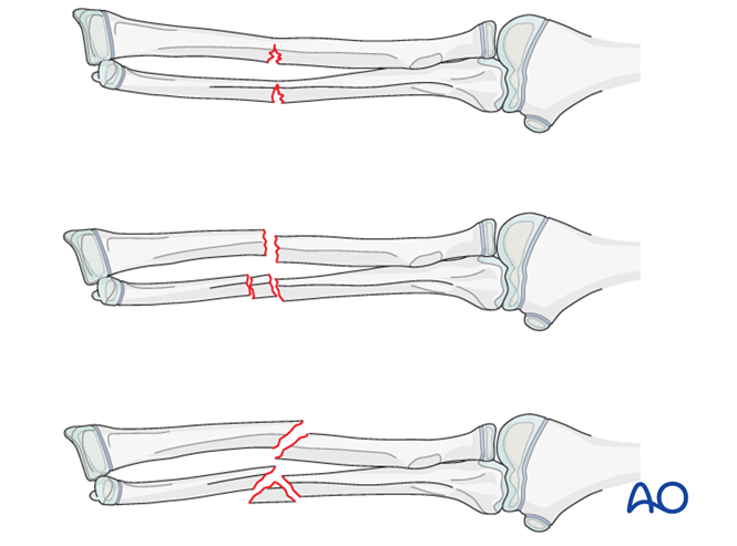 Fracture instability and malalignment