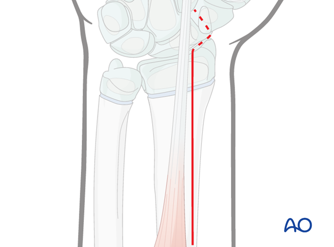 Volar (anterior) approach to the pediatric distal radius
