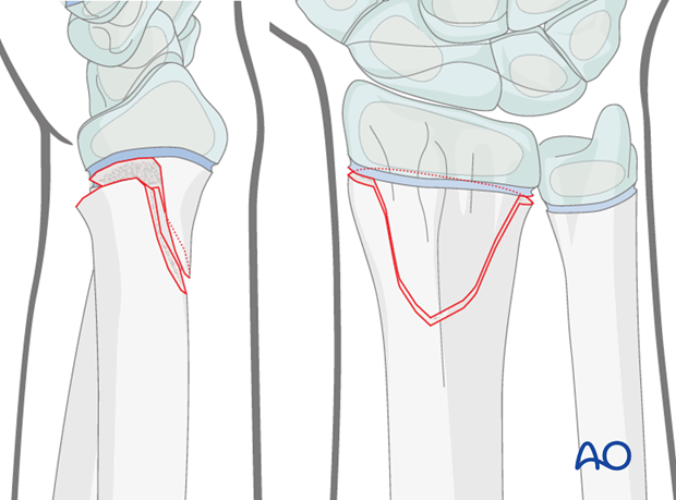 Open Reduction K Wire Fixation For Simple Epiphysiolysis With