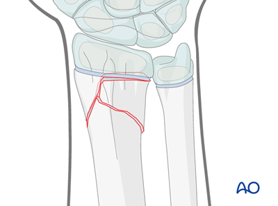 Long arm cast for Multifragmentary epiphysiolysis with metaphyseal ...
