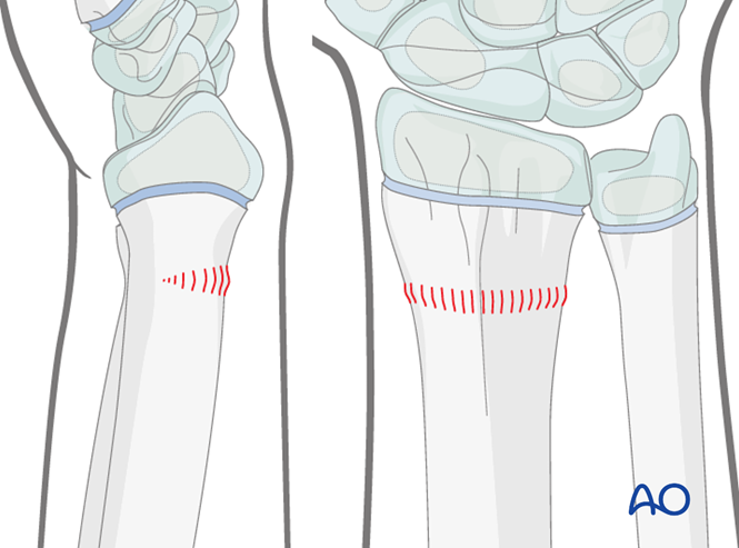 Splint for Metaphyseal, torus/buckle fractures, radius