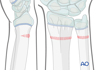 Splint for Metaphyseal, torus/buckle fractures, both bones