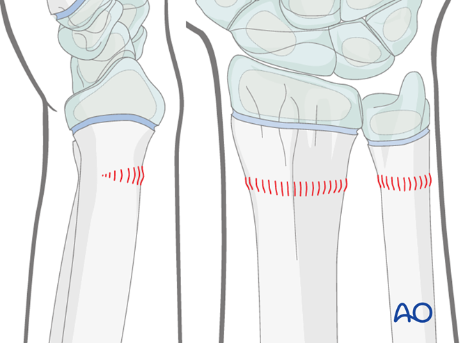 Splint for Metaphyseal, torus/buckle fractures, both bones