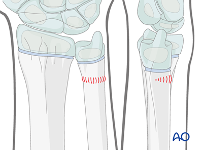 Metaphyseal, torus/buckle fractures, ulna